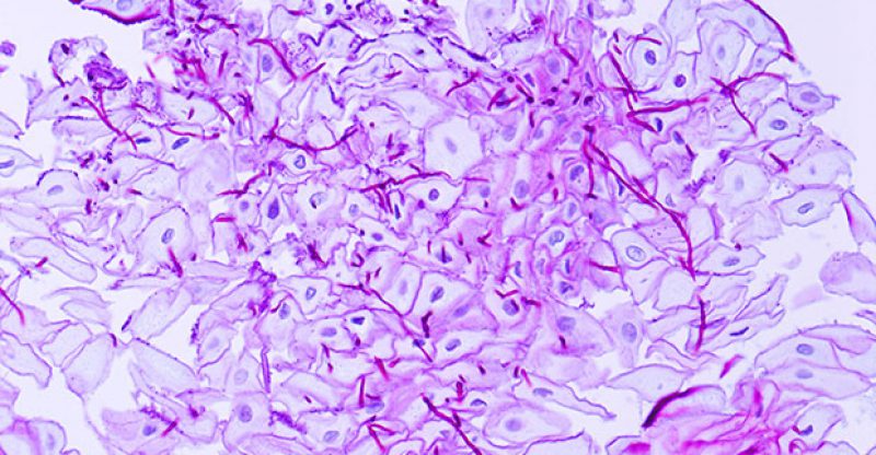 Candidiasis - Síntomas, diagnóstico y tratamiento