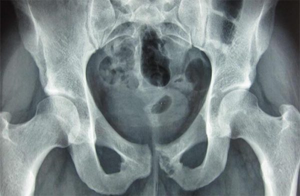 Pubalgia - Síntomas, causas, tratamiento y prevención