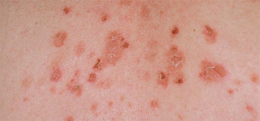 Pénfigo - Síntomas, causas, tipos y tratamiento